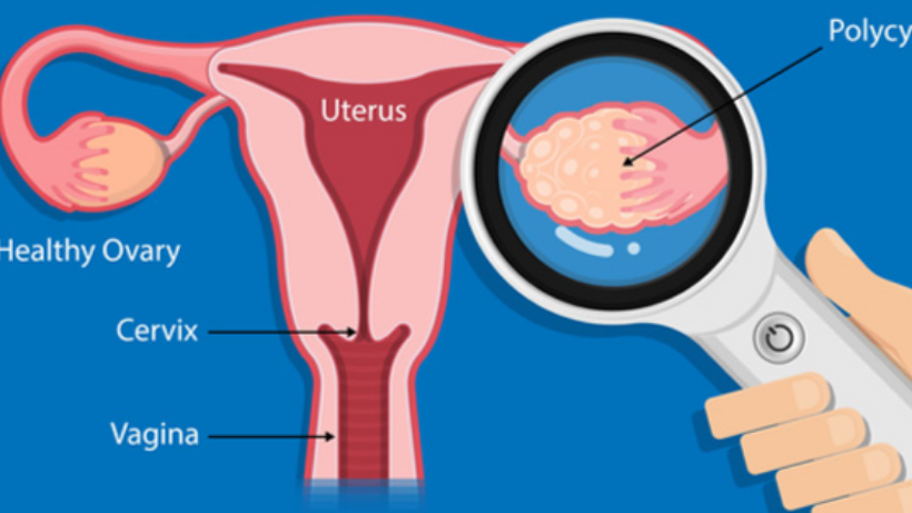 Manage PCOS Effectively: Here Is How? | HealthTrip
