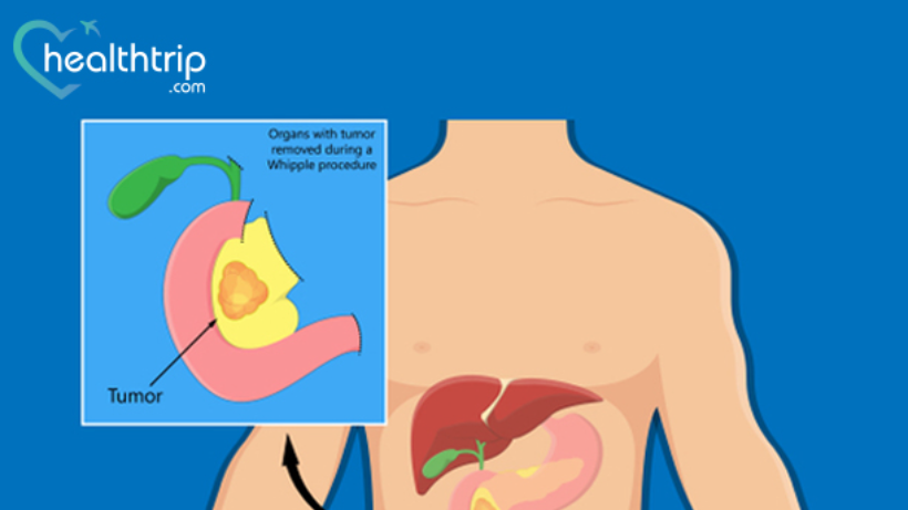 Life After Whipple Surgery for Pancreatic Cancer | HealthTrip | HealthTrip