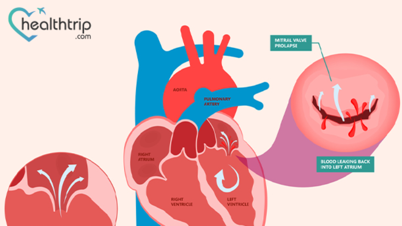Ce que vous devez savoir sur le remplacement de la valvule mitrale ...