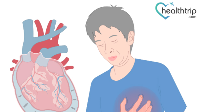 Is Pericardiectomy surgery a complicated procedure? | HealthTrip