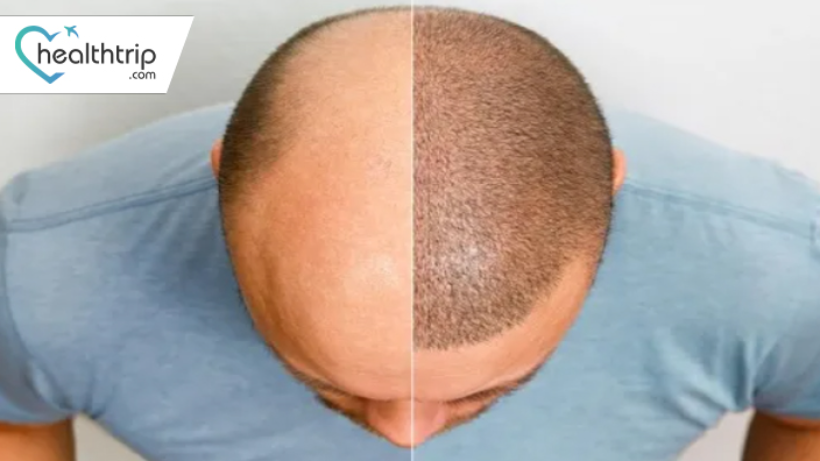 Best Clinics for Hair Transplant in India | HealthTrip