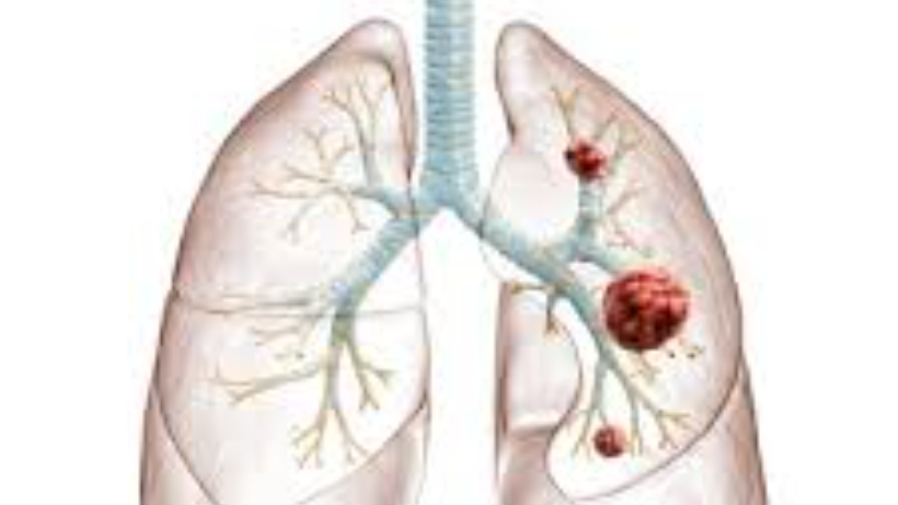 Lung Carcinoid Tumors: Symptoms, Diagnosis, and Treatment